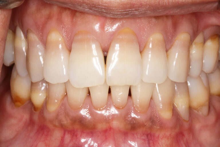 How Bioclear Works: A Dental Transformation