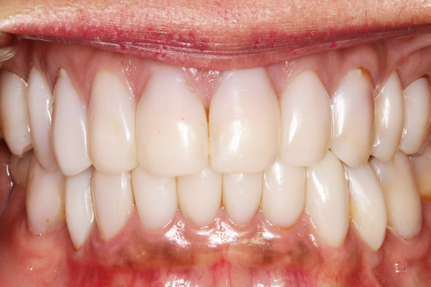 How Bioclear Works: A Dental Transformation