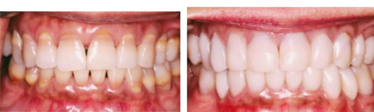Bioclear Before and After: See How It Transforms Your Smile