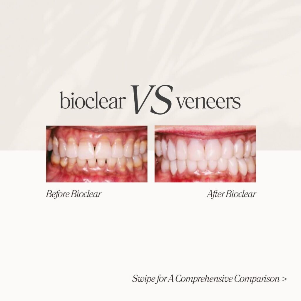 Bioclear or Veneers: Which Enhances Your Smile Best?